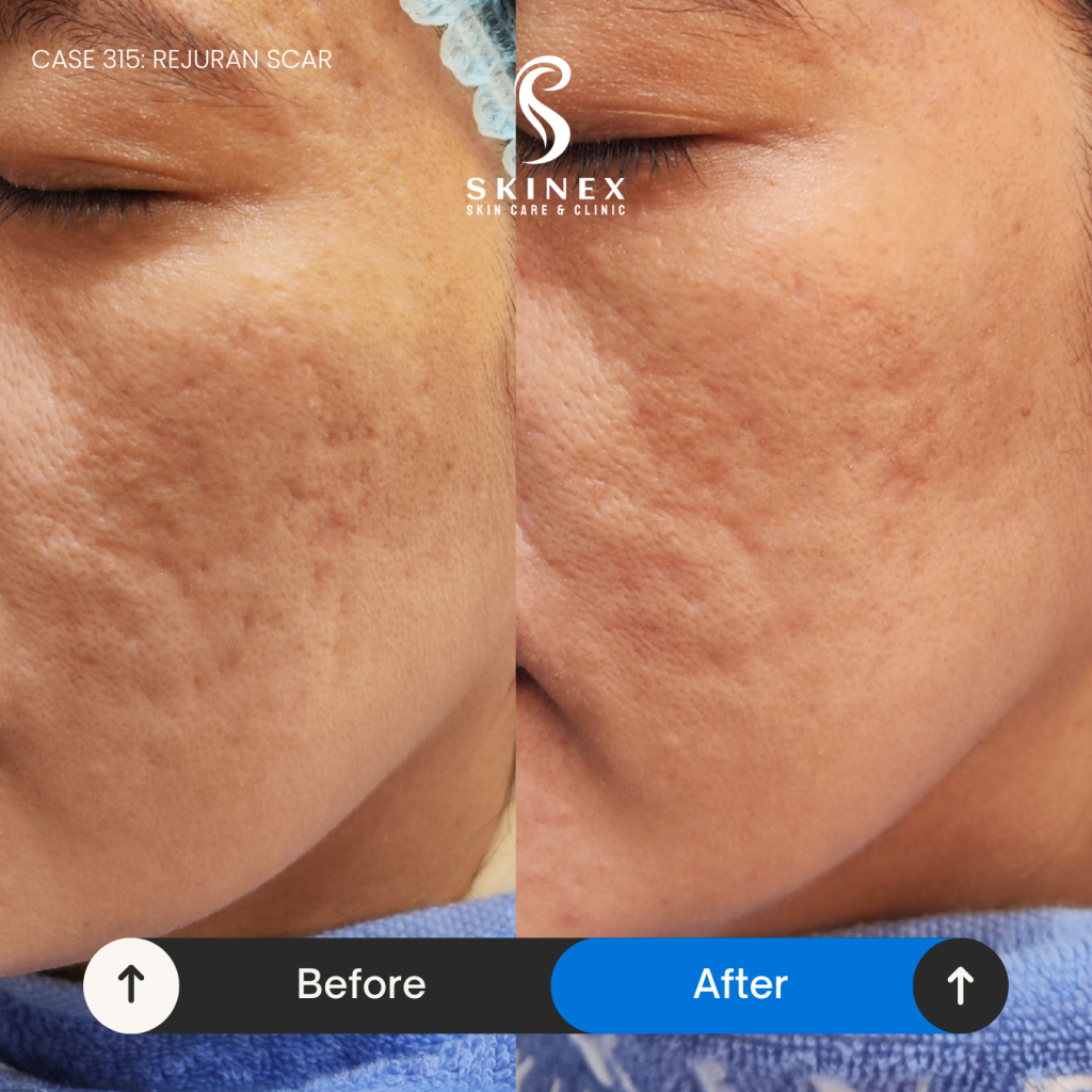 Rejuran Healer vs I vs S: Mana yang Tepat untuk Kulitmu? | Skinex Bintaro