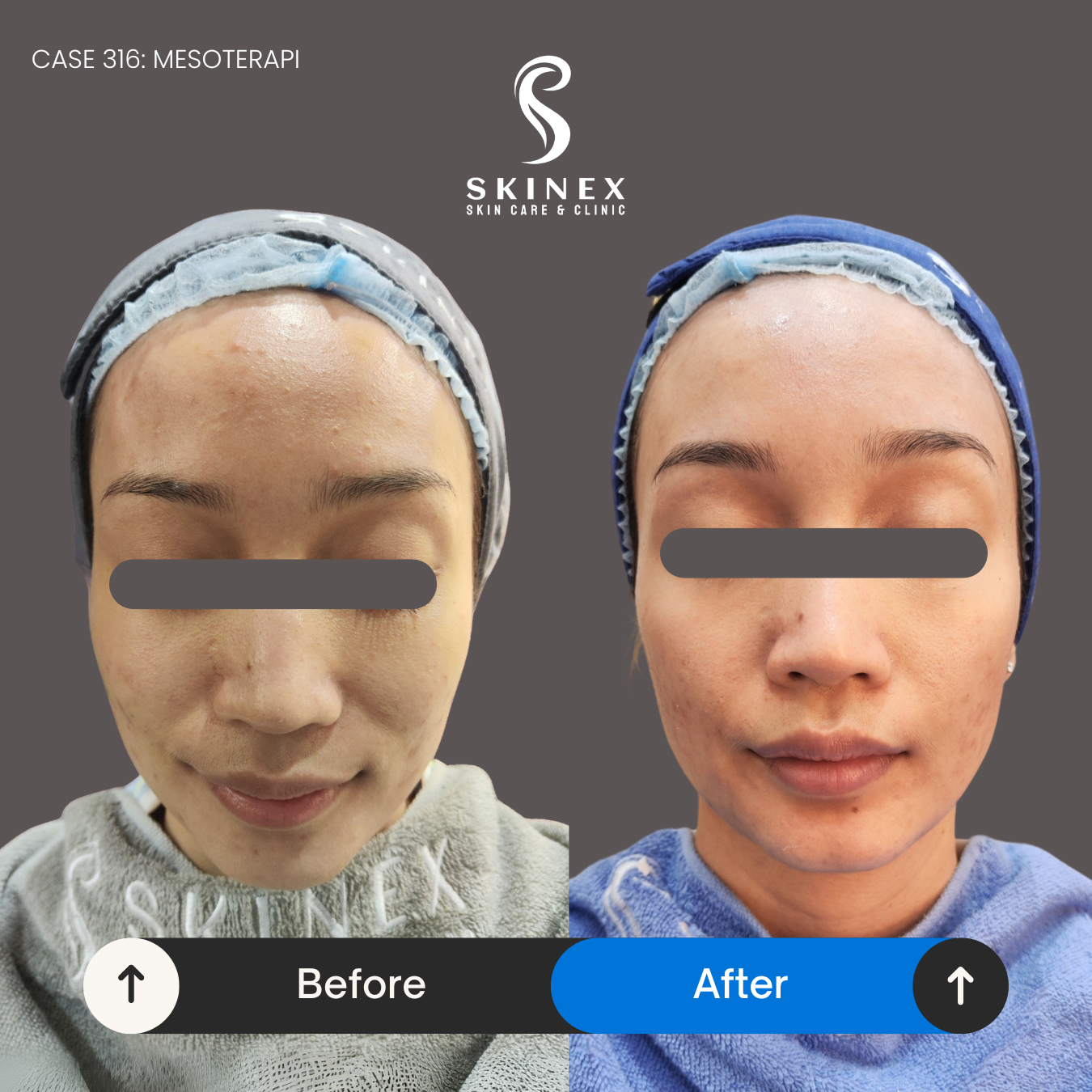 Pico Laser Rejuve - Skinex Skin Clinic
