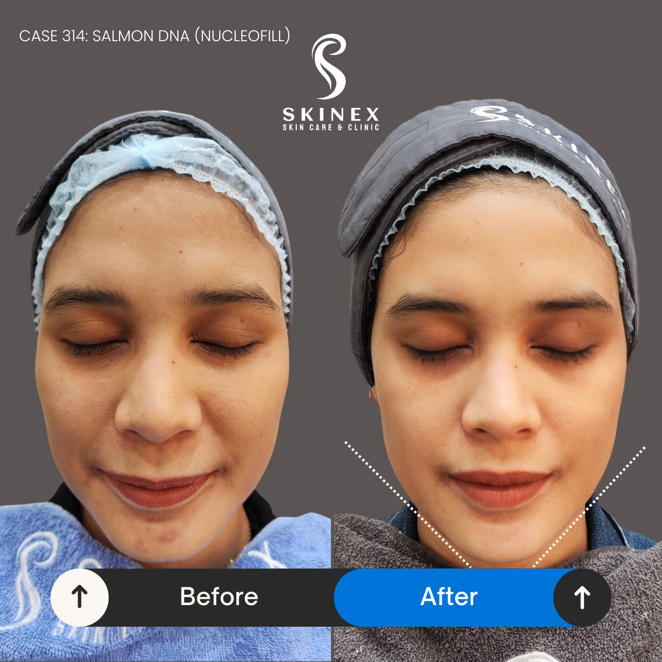 Salmon DNA Treatments - Skinex Skin Clinic